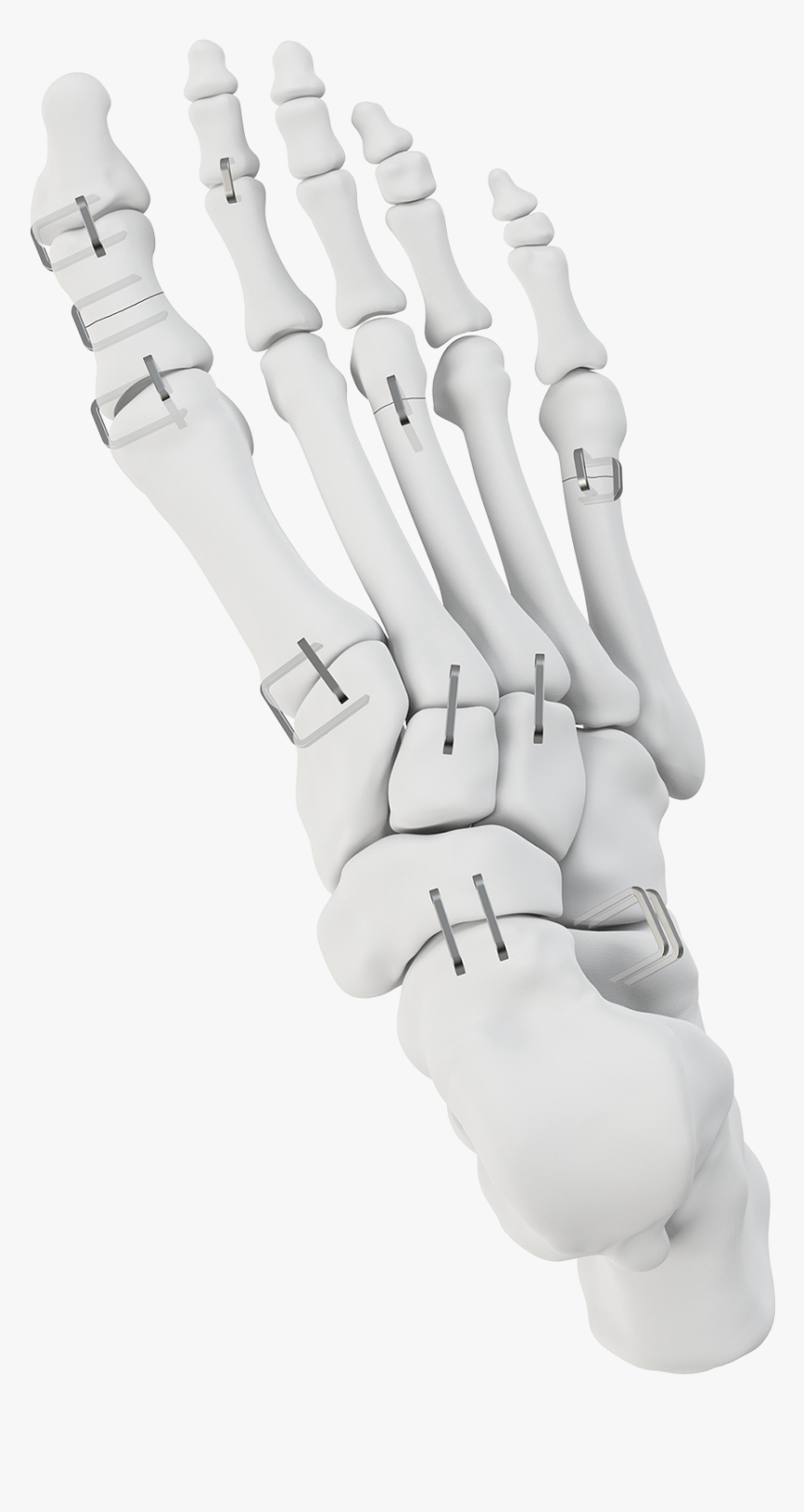 Nitinol Staples Implant Graphic, HD Png Download - kindpng